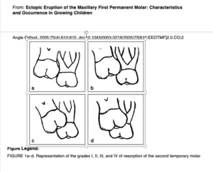 Primeiro molar impactado - Orthoped