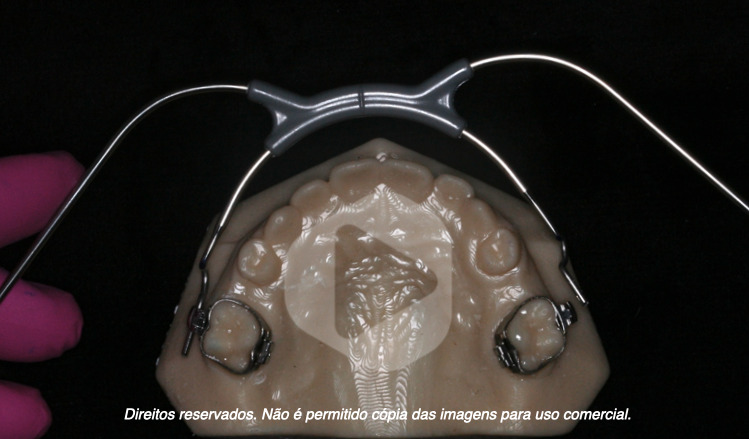 Instalação e ajuste AEB | Ebook- Orthoped