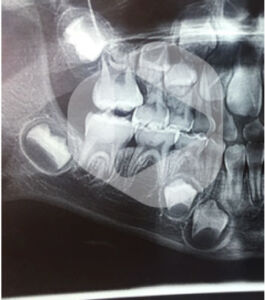 Primeiro molar impactado - Orthoped