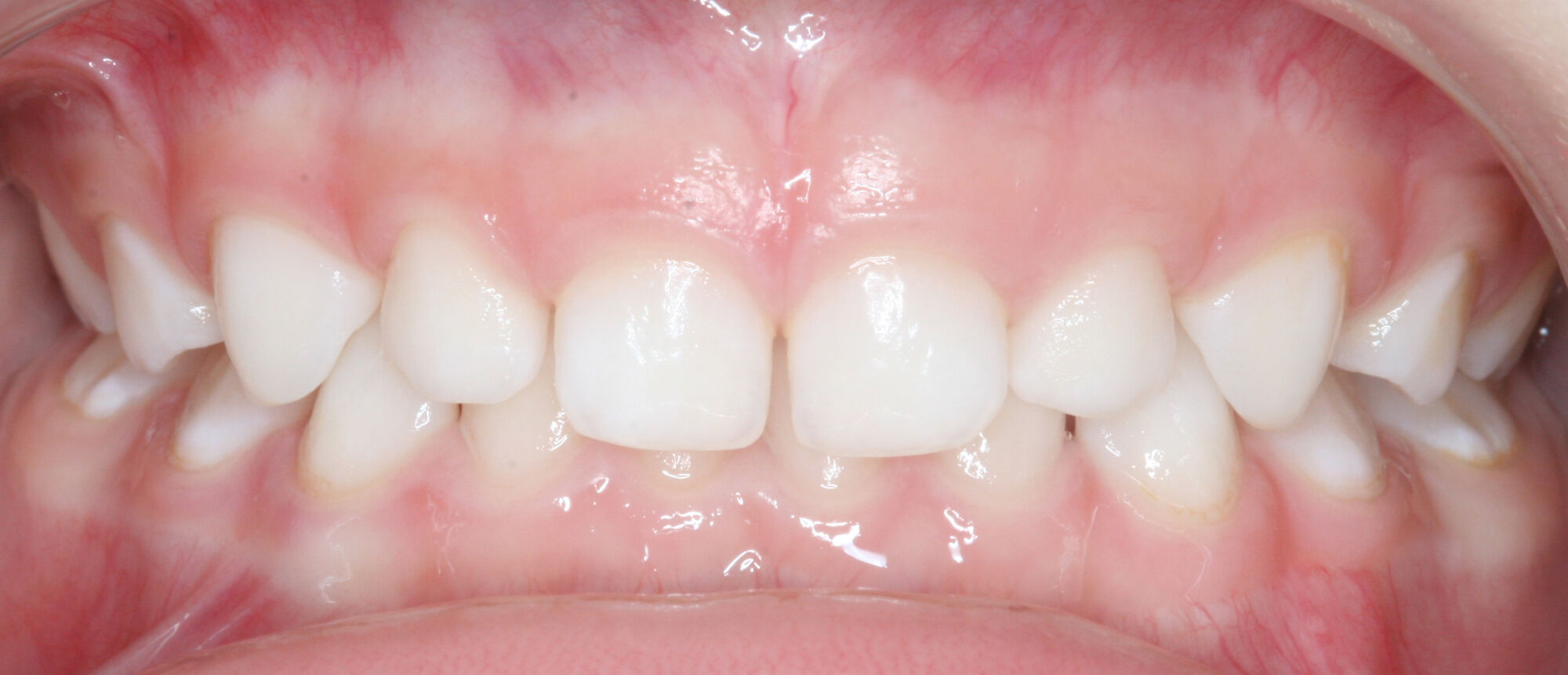 Dentição decídua: o que avaliar no exame ortodôntico? - Orthoped