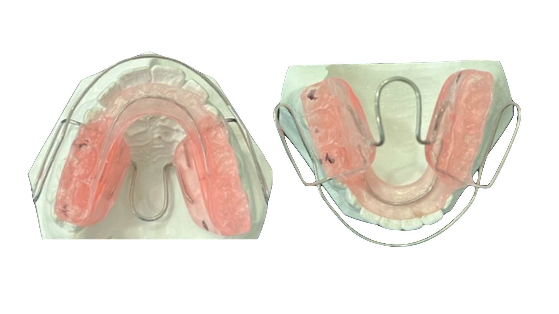 Módulo 10 - OFM e Bionator de Balters - Orthoped