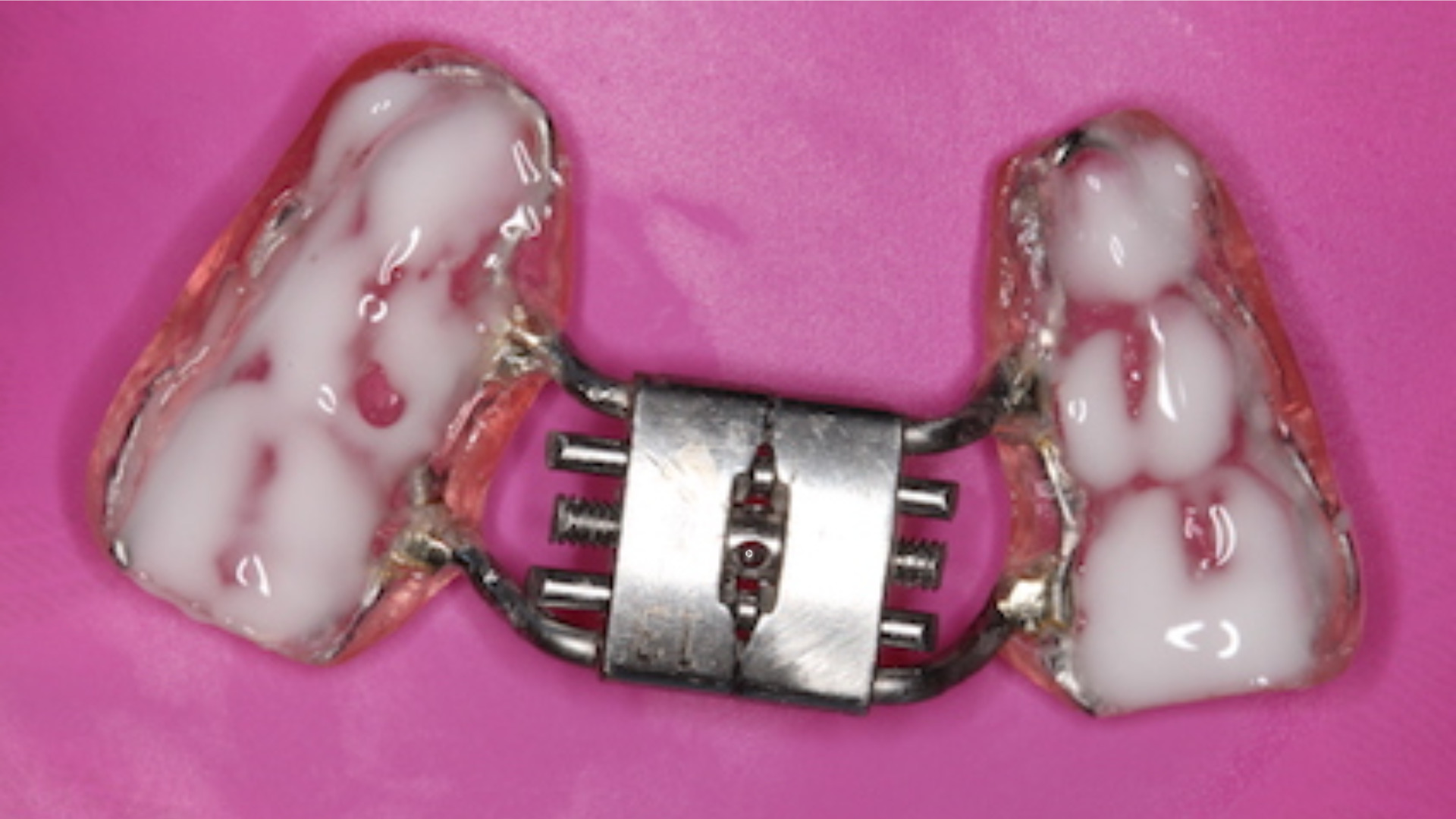 Expansor encapsulado, qual o segredo da cimentação?